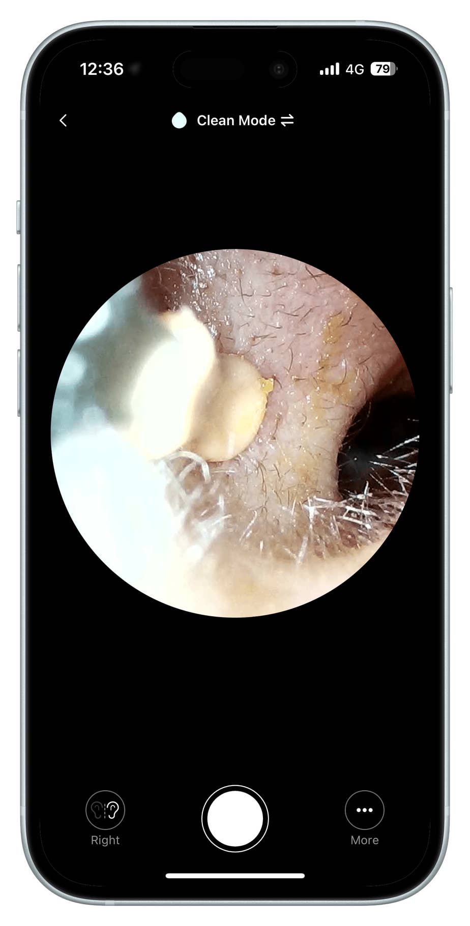 Test du Bebird Earvision: Un otoscope connecté pour nettoyer vos oreilles